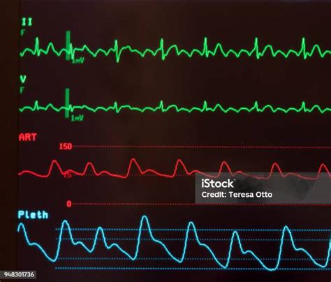 Close Up Dari Ekg Dengan Atrial Flutter Foto Stok Unduh Gambar