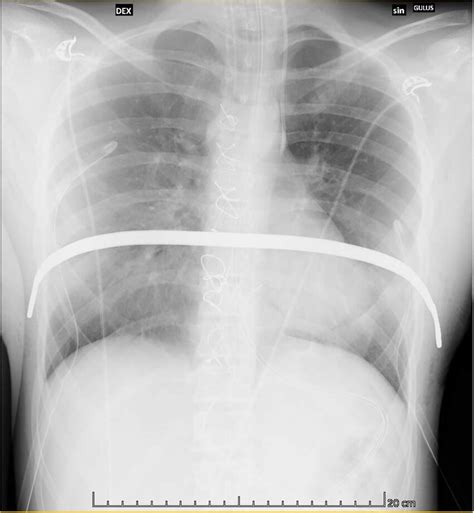 Pectus Excavatum Chest X Ray