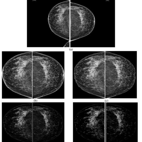 proposed pre processing segmentation of bilateral cases a the