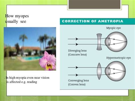 Refraction In Different Refractive Errors And Their Management