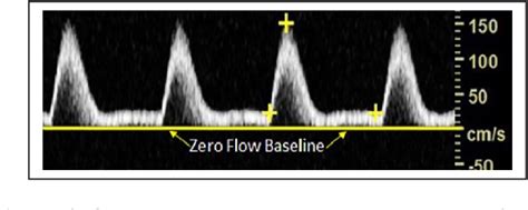 Figure 1 From Interpretation Of Peripheral Arterial And Venous Doppler Waveforms A Consensus