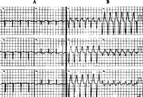 figure 1 from exercise induced left bundle branch block during thallium