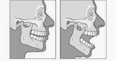 Tmj Dislocation Reduction Flashcards Quizlet