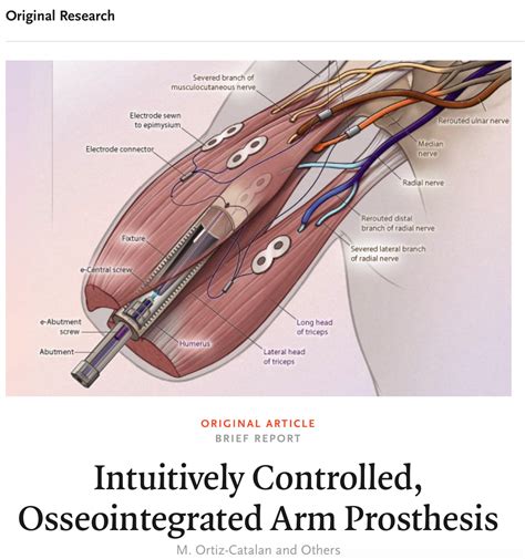 Found This In The New England Journal Of Medicine Rdeusex