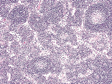 Pathology Outlines Mantle Cell Marginal Zone Hyperplasia