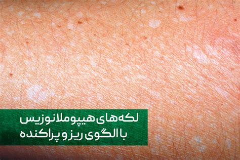 انواع لکه های سفید پوستی با تصویر علت، علائم و درمان خانگی داروخانه