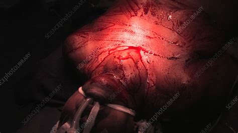 Goitre Removal Surgery Stock Video Clip K011 0598 Science Photo Library