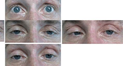 Motility Note Bilateral Abduction Deficits In Right And Left Gaze Download Scientific Diagram