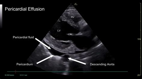 Pocus Echo Pericardial Vs Pleural Effusions Youtube