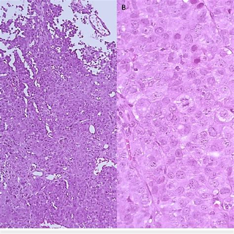 Hematoxylin And Eosin Stain A Sheets Of Cells Large Cells With Big Download Scientific Diagram