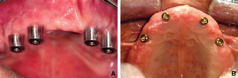Retention Of Telescopic Versus Locator Attachments And Marginal Bone