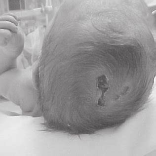 A Group Of Scalp Defects Are Seen At The Vertex Download Scientific Diagram