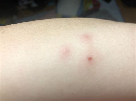 피부과 가야할까요 지식in