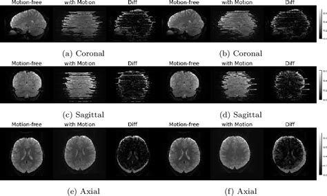 A Self Attention Model For Robust Rigid Slice To Volume Registration Of