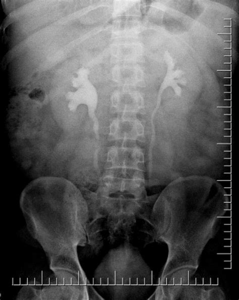 Intravenous Urography Pacs