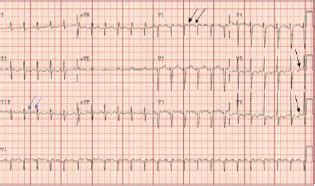 Diagnosing Atypical Flutter In The Post Atrial Fibrillation Ablation Patient A Case Report