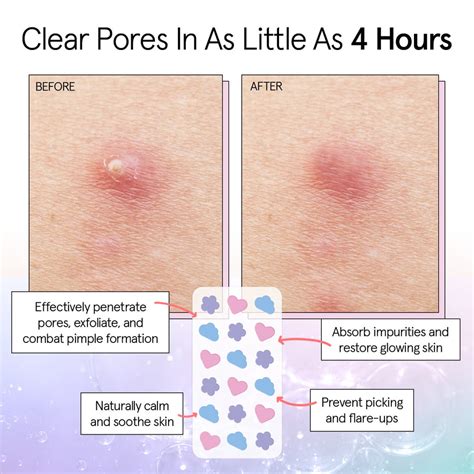 Best Pimple Patches With Cute Shapes By Grace And Stella