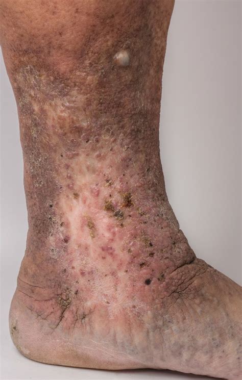 Varicose Vein Risks Mild To Severe