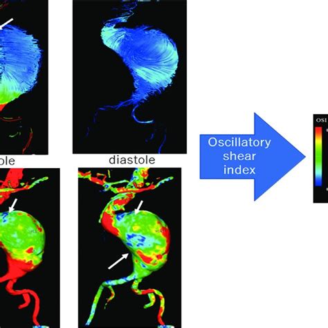 Various Hemodynamic Assessments Using 4d Flow Mri For A Male Patient In