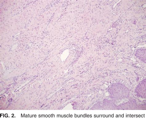 Figure 2 From Temporal Bone Histopathology Case Of The Month Angioleiomyoma Of The External