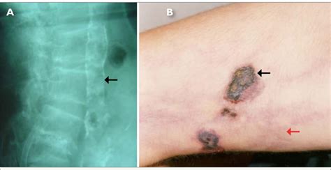 Vascular Calcification In Two Patients On Maintenance Dialysis Panel A Download Scientific