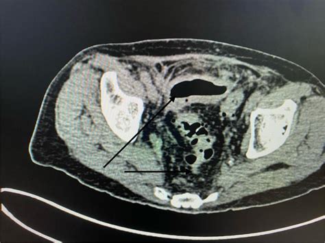 Diverticulitis Challenging Situations In Colonic Diverticulitis Case