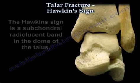 Talus Fracture Hawkins Sign Everything You Need To Know Dr Nabil