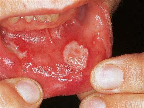 Pyostomatitis Vegetans Histology