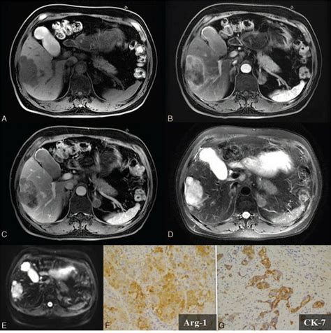 A 58 Year Old Man With A Combined Hepatocellular And Cholangiocarcinoma