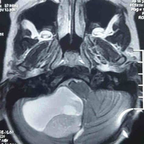 Ct Image Shows Solid Cystic Lesion In Right Cerebellum With