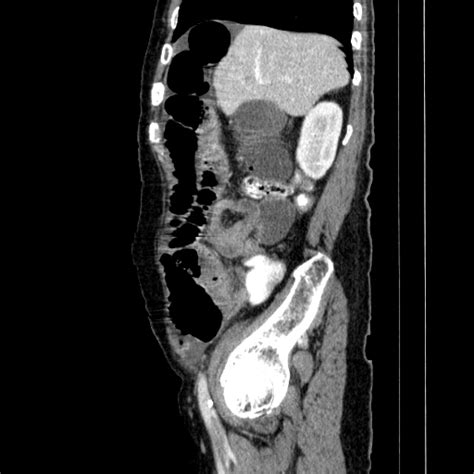 File Small Bowel Volvulus Causing Small Bowel Obstruction Mimicking Intussusception