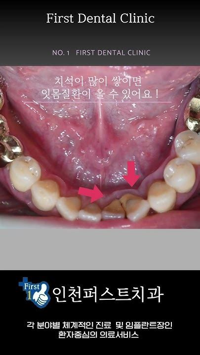 👉 이걸 빼고 나면 입냄새가 사라집니다” Youtube