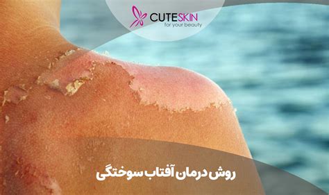 10 روش درمان آفتاب سوختگی و مراقبت از پوست بعد از سوختن کیوت مگ