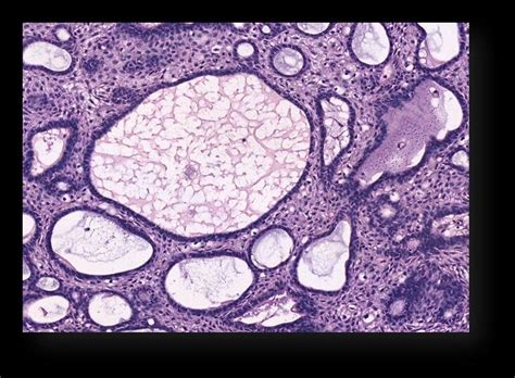 Stellate Reticular Pattern And Reverse Polarization Which Resemble