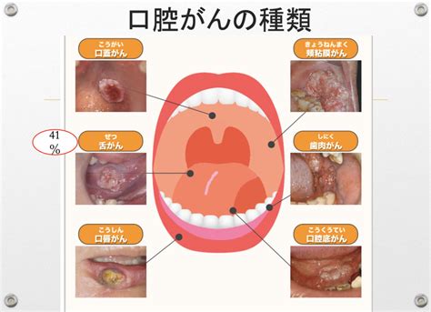 歯科医院で救える命がある！〜口腔がん検診のすすめ〜 医療法人いいだの森歯科こども歯科クリニック 長野県飯田市