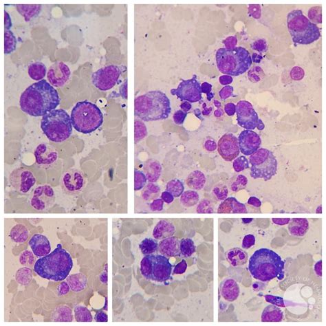 Plasma Cell Myeloma