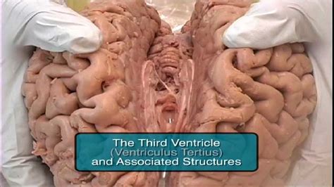 Third Ventricle And Interthalamic Adhesion From Dissection Of The Brain And Spinal Cord B