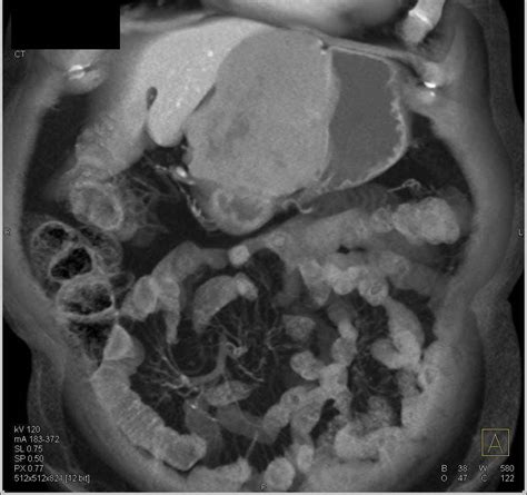Gastric Gist Tumor Stomach Case Studies Ctisus Ct Scanning