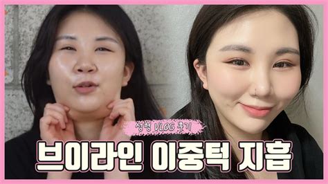 [얼굴지방흡입 볼살지방흡입 이중턱 제거 2탄]♥22살 수정씨의 초역대급 레게노 3달동안의 변화과정 후기♥사각턱 보름달 젖살 얼굴이 이영상 안보면 진심 후회 플tv