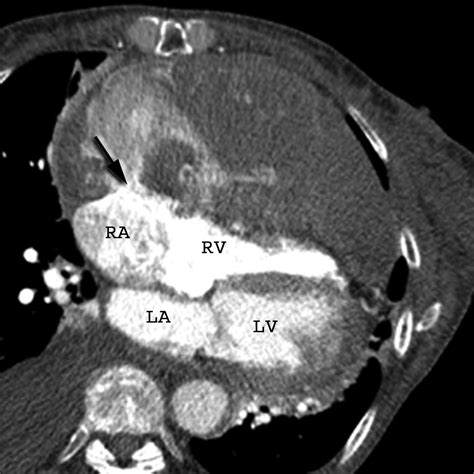 Primary Angiosarcoma Of The Heart Heart