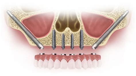 Cheekbone Zygomatic Dental Implants Nm Dental