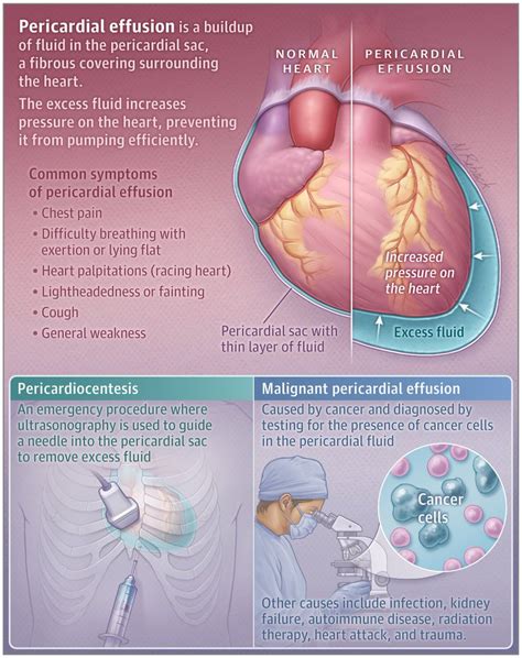 Pericardial Sac Comprehensive Overview Of Heart Anatomy Galaxyai