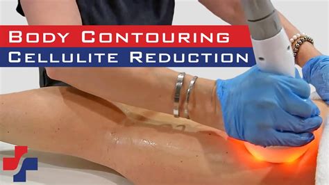 Body Contouring And Cellulite Reduction With The Most Popular Radio