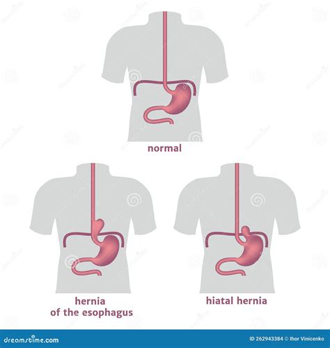 Paraesophageal Hiatus Hernia Type 2 3d Rendering Royalty Free Stock