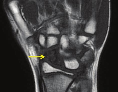 Scaphoid Fracture Mri Scaphoid Fractures Are The Most Common Carpal
