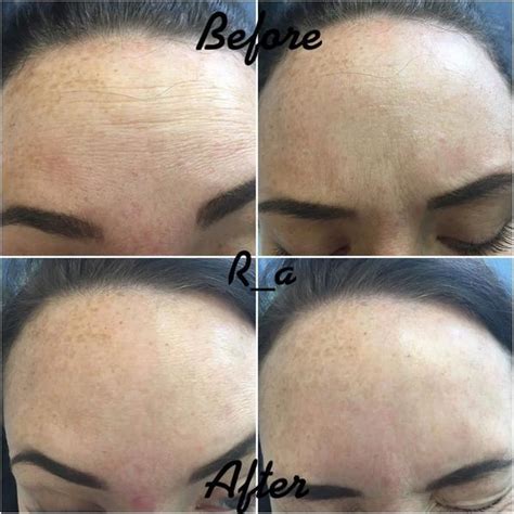 Preventative Botox Forehead Before And After Pics Facial Injections