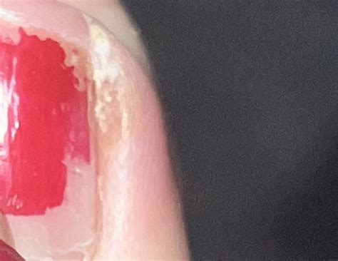 Tror Jeg Har Sopp I Negl Eller Hud Kropp Og Helse Kvinneguiden Forum