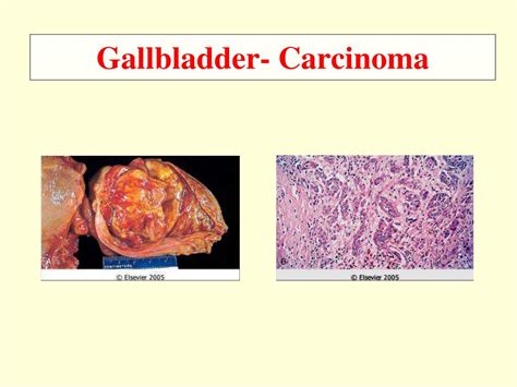 Ppt Mc Congenital Anomalies Abnormal Variants Of The Gallbladder Mc