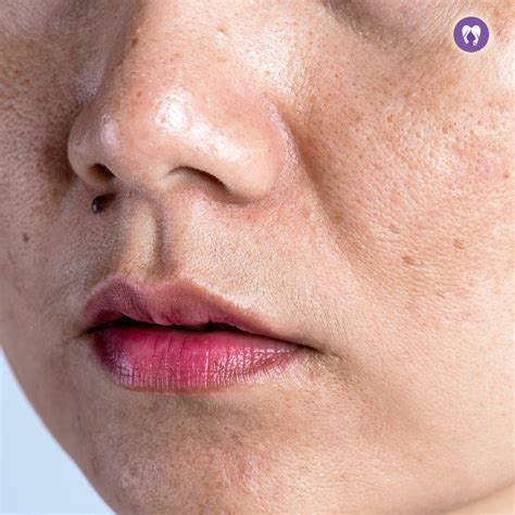 Melasma Treatment At Rootcosmo Unveil Radiant Skin
