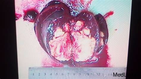 脾脏占位一例 医联